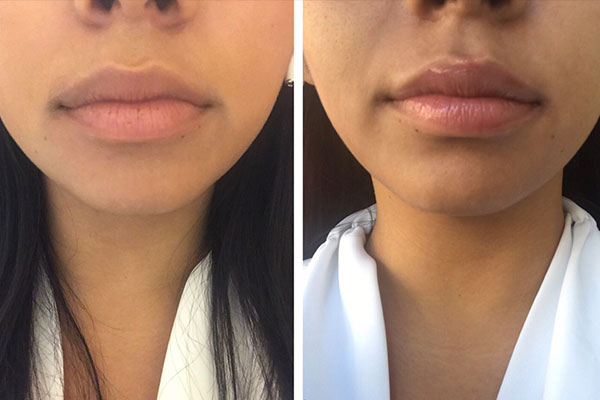 Gallery San Carlos, CA | Premier Dermatology